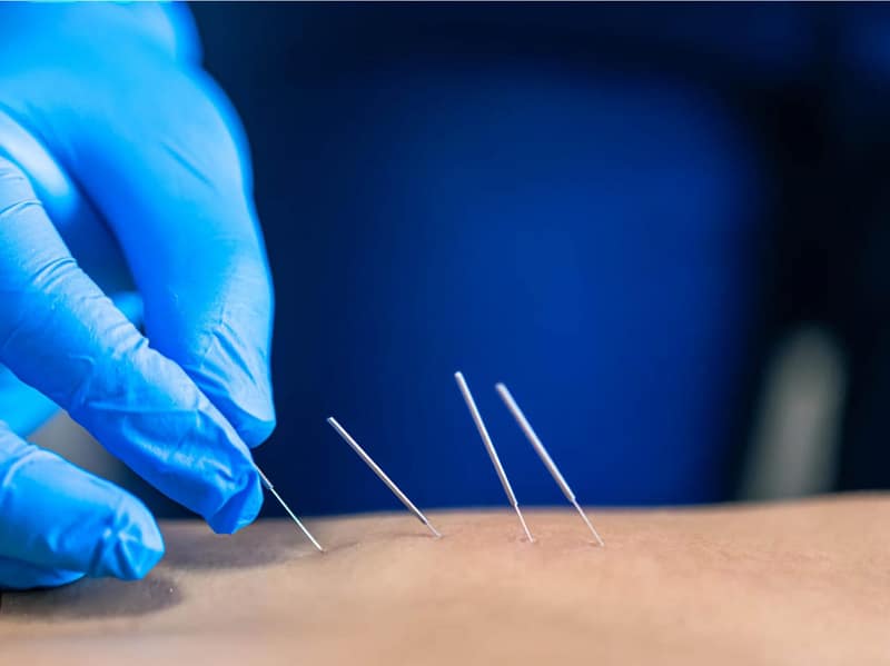 FFC Wellness: Effective Dry Needling for Pain Relief